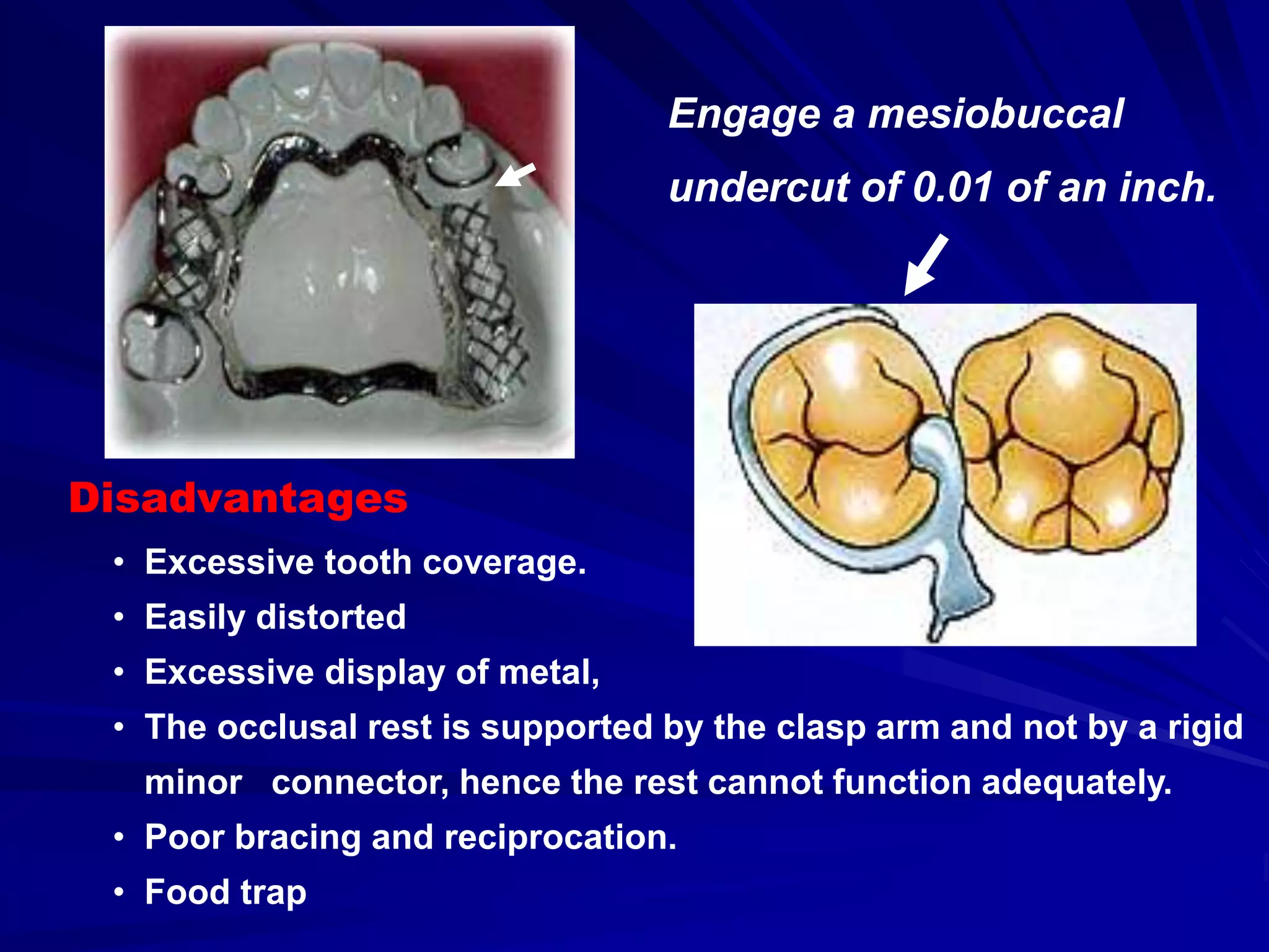B- Retention of Removable Partial Dentures | PPT