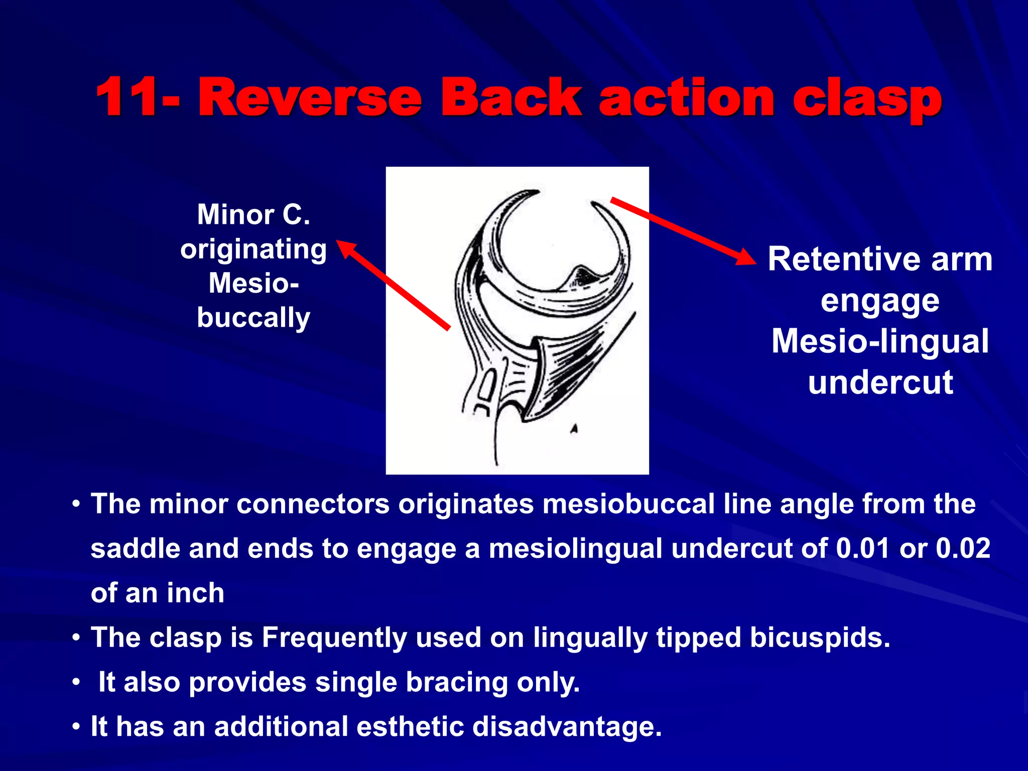 B- Retention of Removable Partial Dentures | PPT