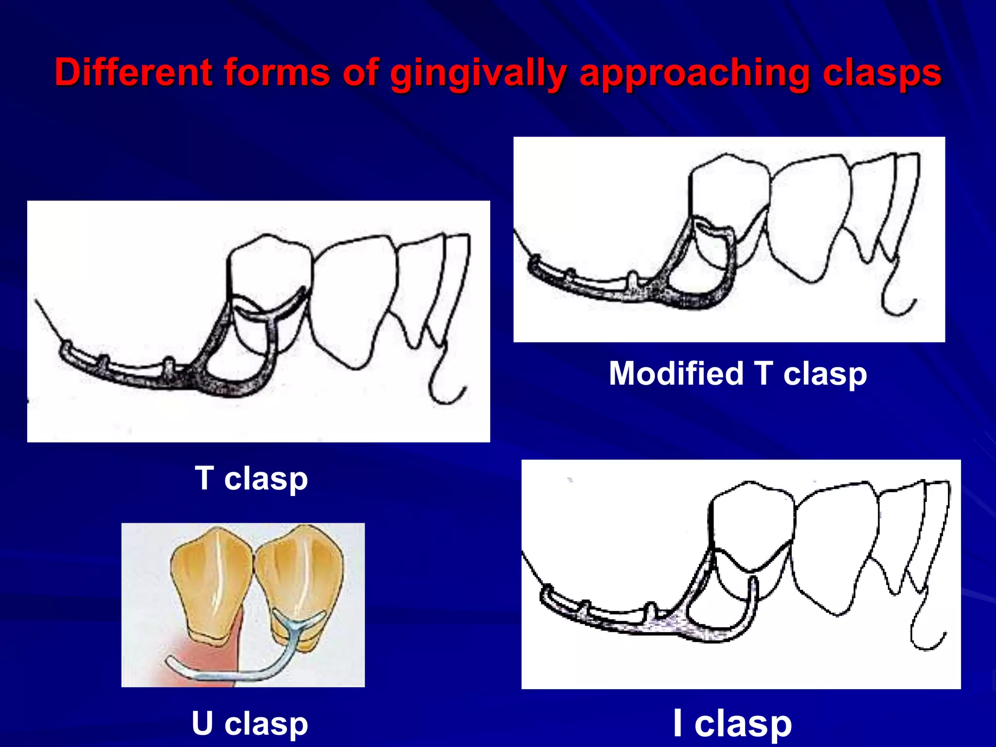 B- Retention of Removable Partial Dentures | PPT