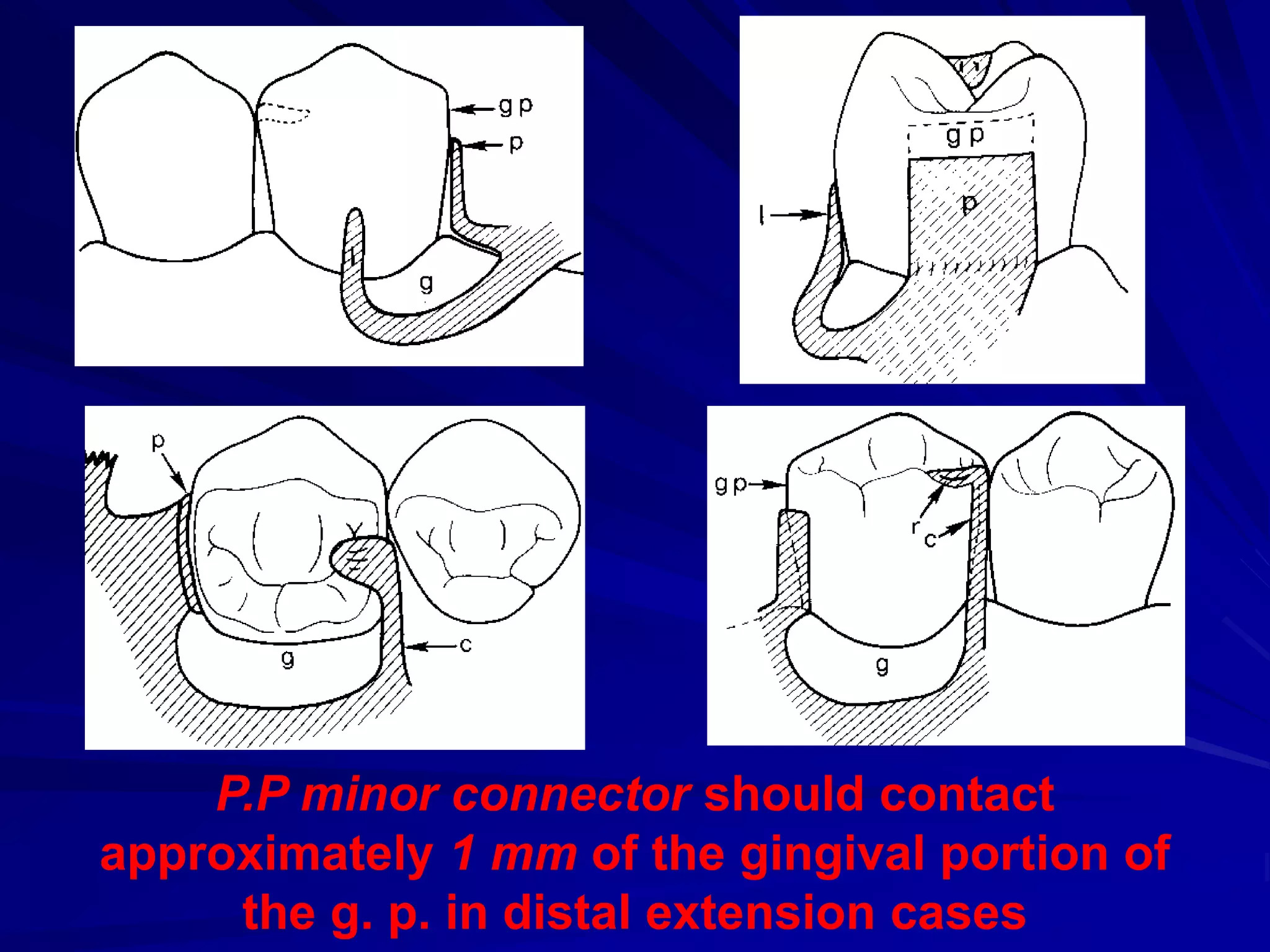 B- Retention of Removable Partial Dentures | PPT