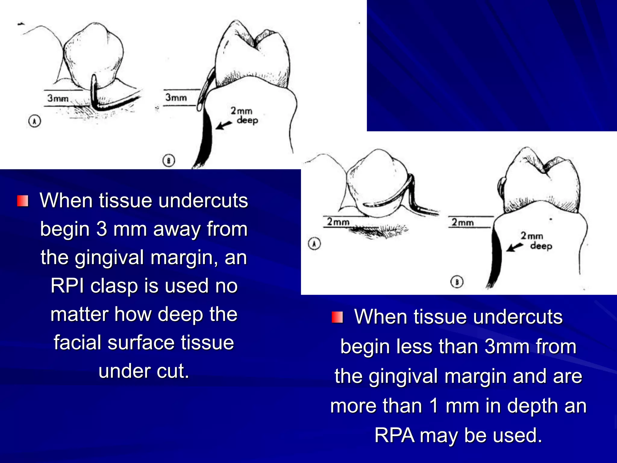 B- Retention of Removable Partial Dentures | PPT