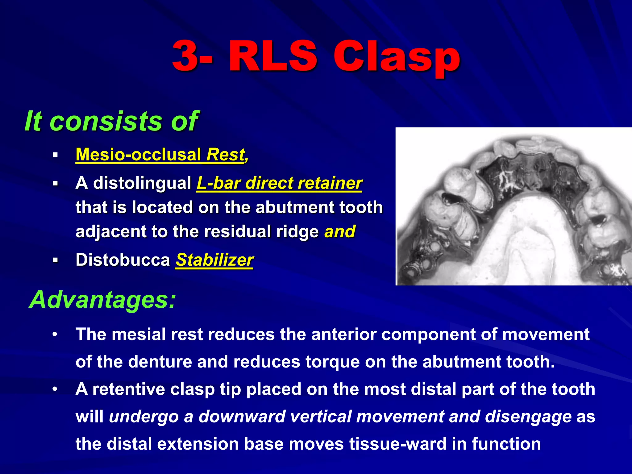 B- Retention of Removable Partial Dentures | PPT