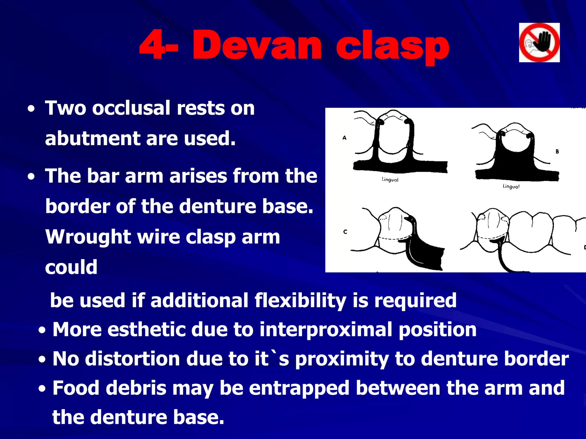 B- Retention of Removable Partial Dentures | PPT