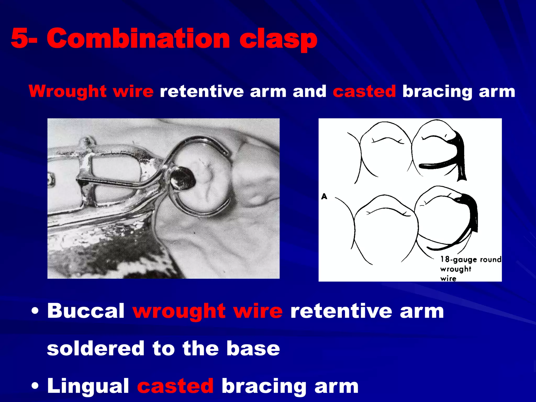 B- Retention of Removable Partial Dentures | PPT