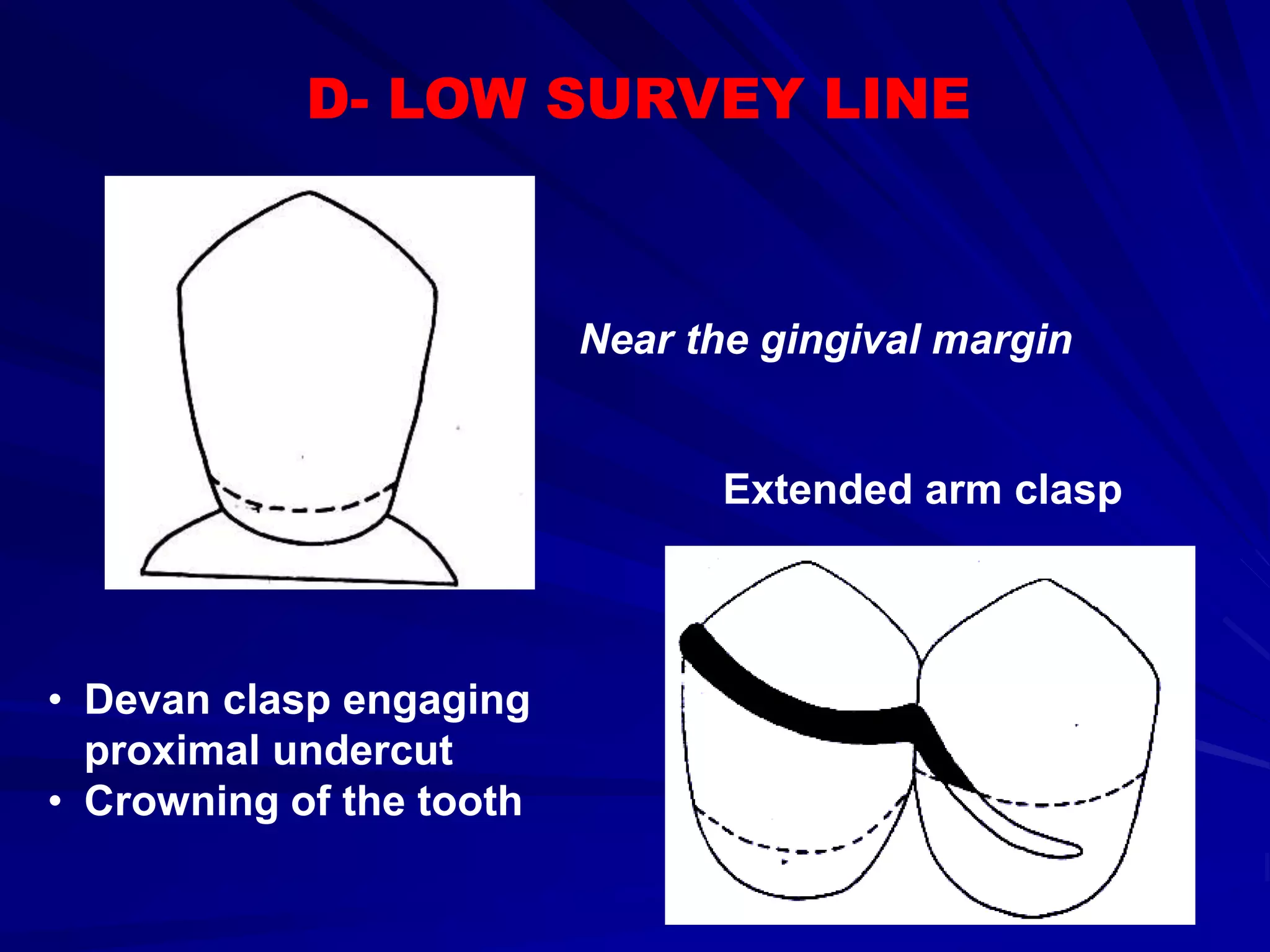 B- Retention of Removable Partial Dentures | PPT
