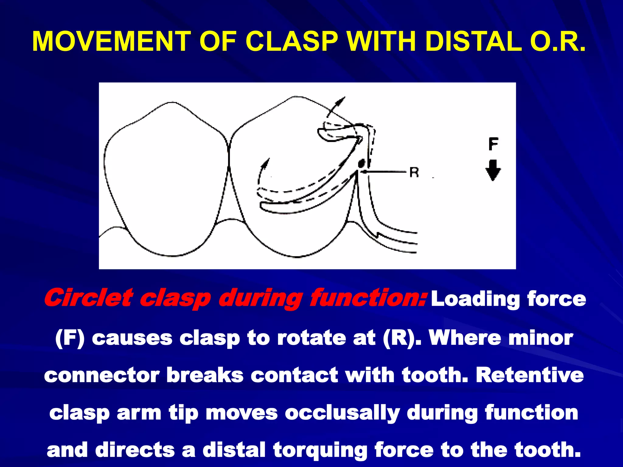 B- Retention of Removable Partial Dentures | PPT