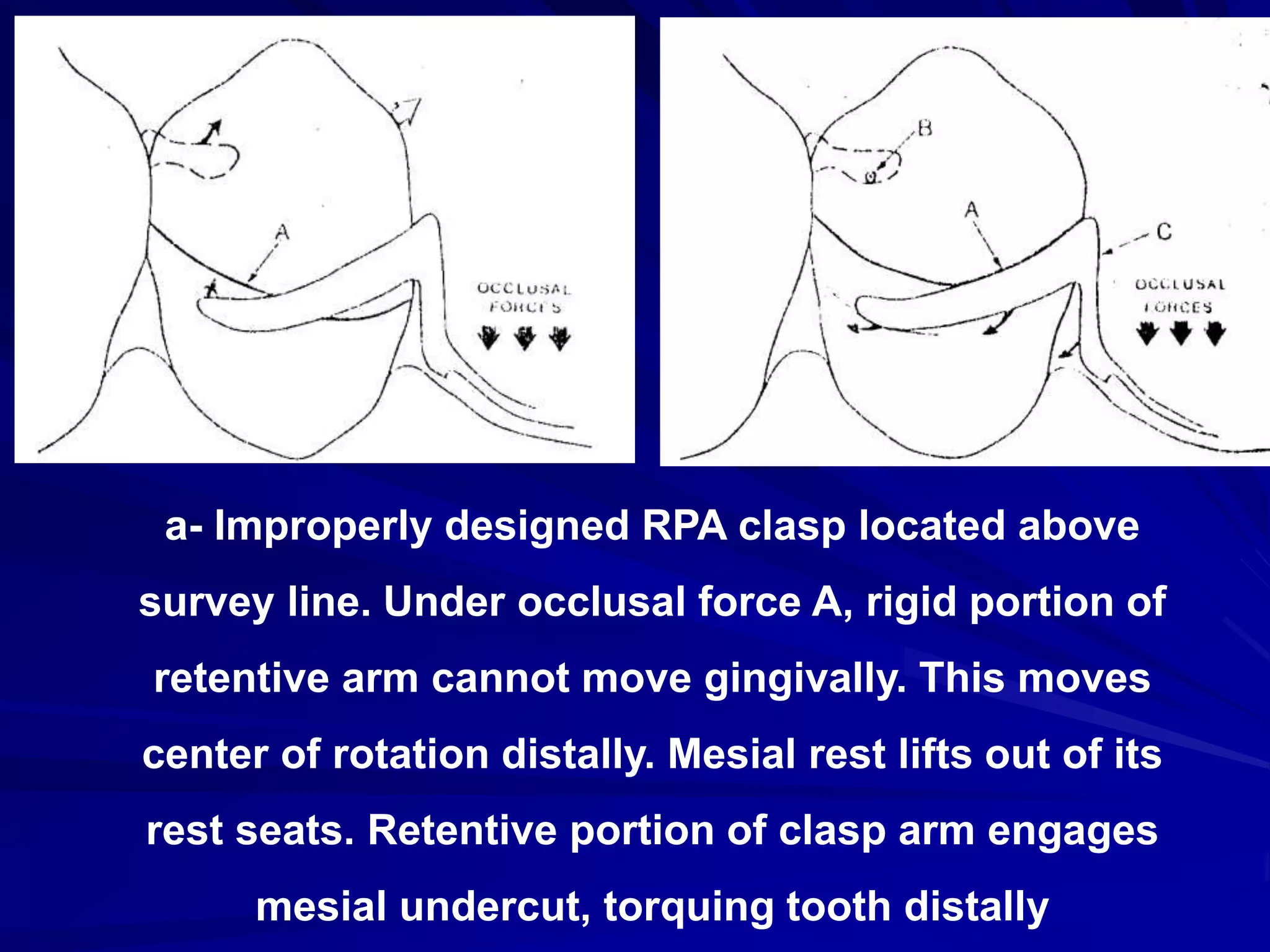 B- Retention of Removable Partial Dentures | PPT