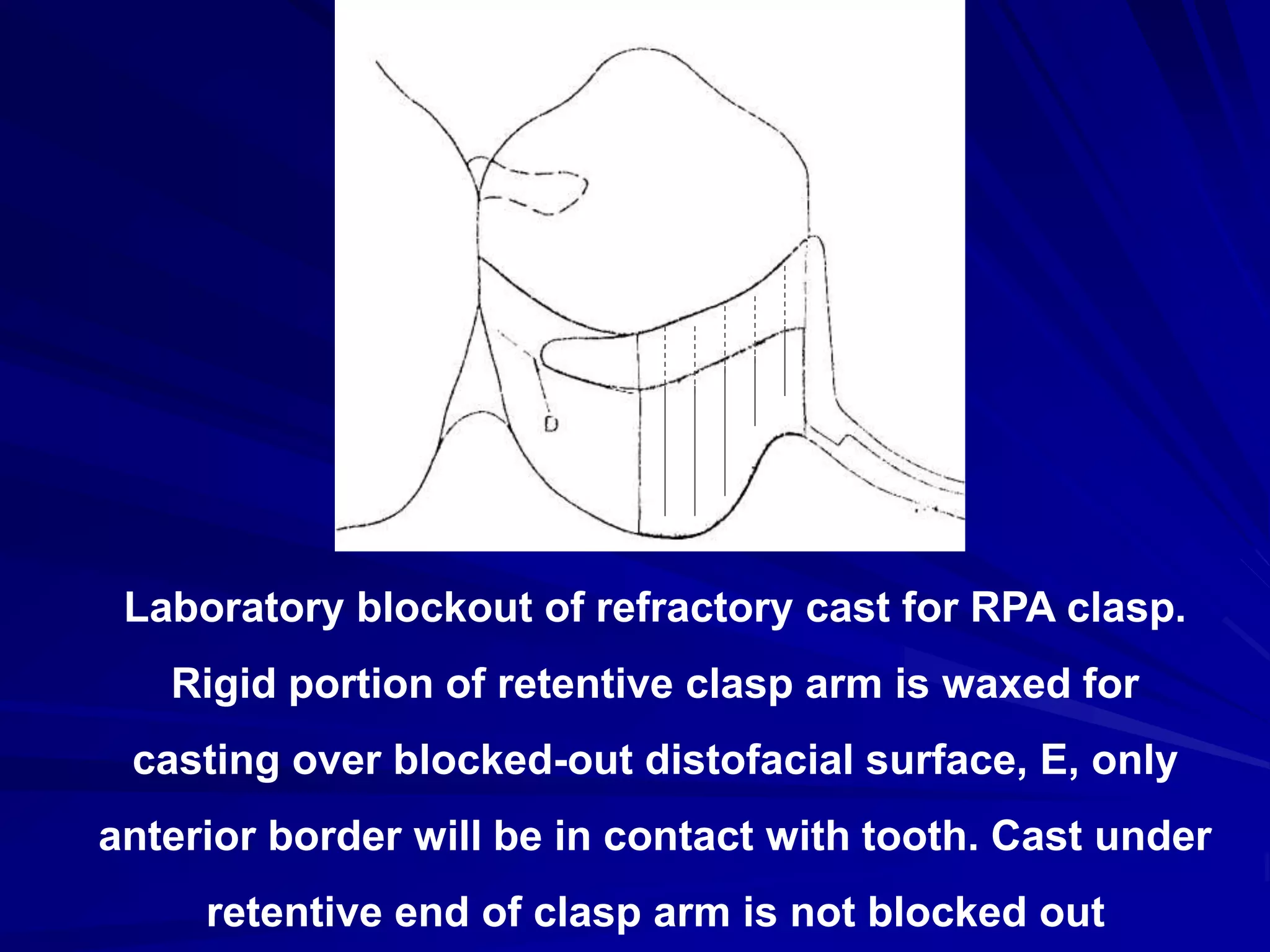 B- Retention of Removable Partial Dentures | PPT