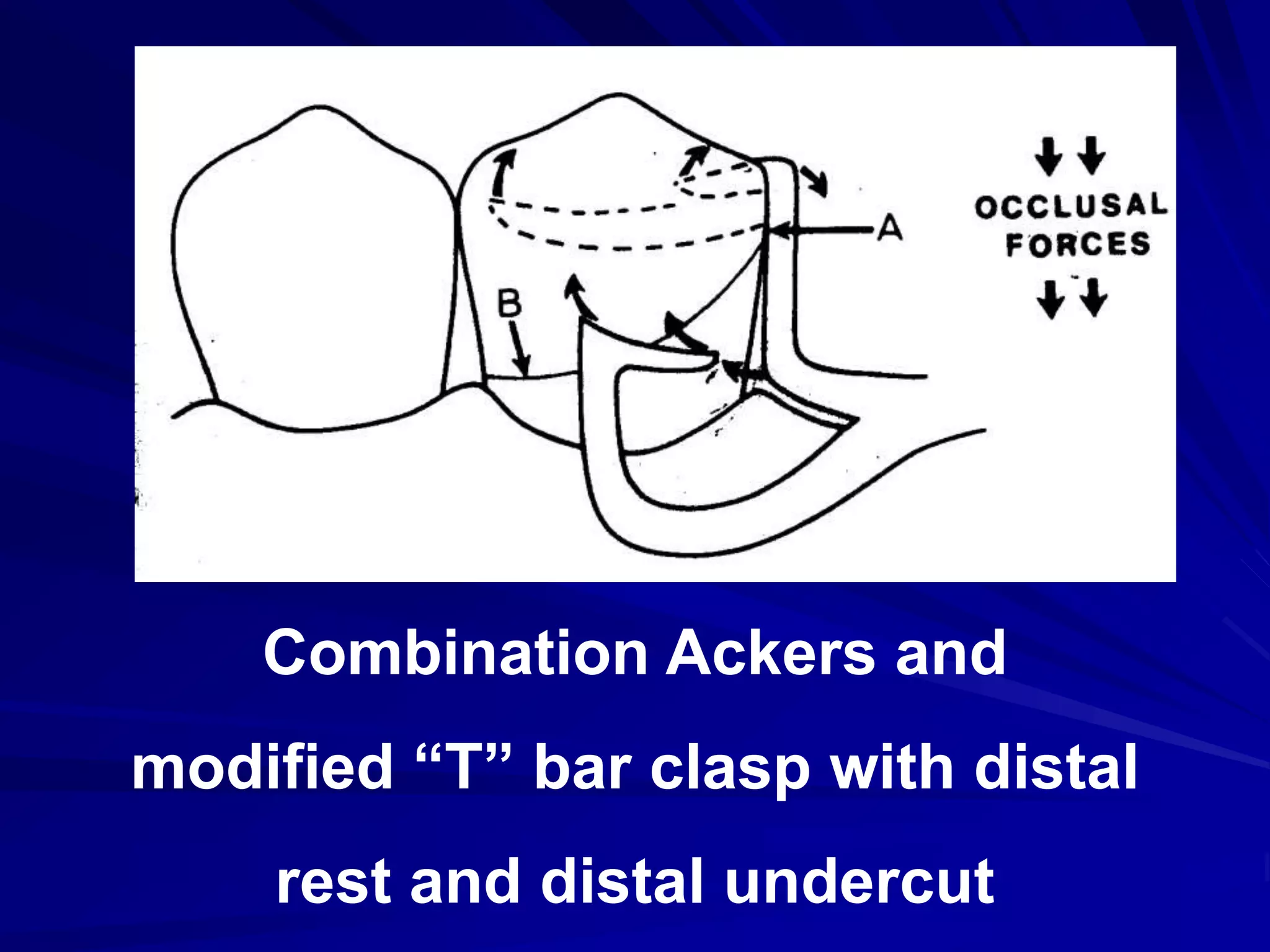 B- Retention of Removable Partial Dentures | PPT