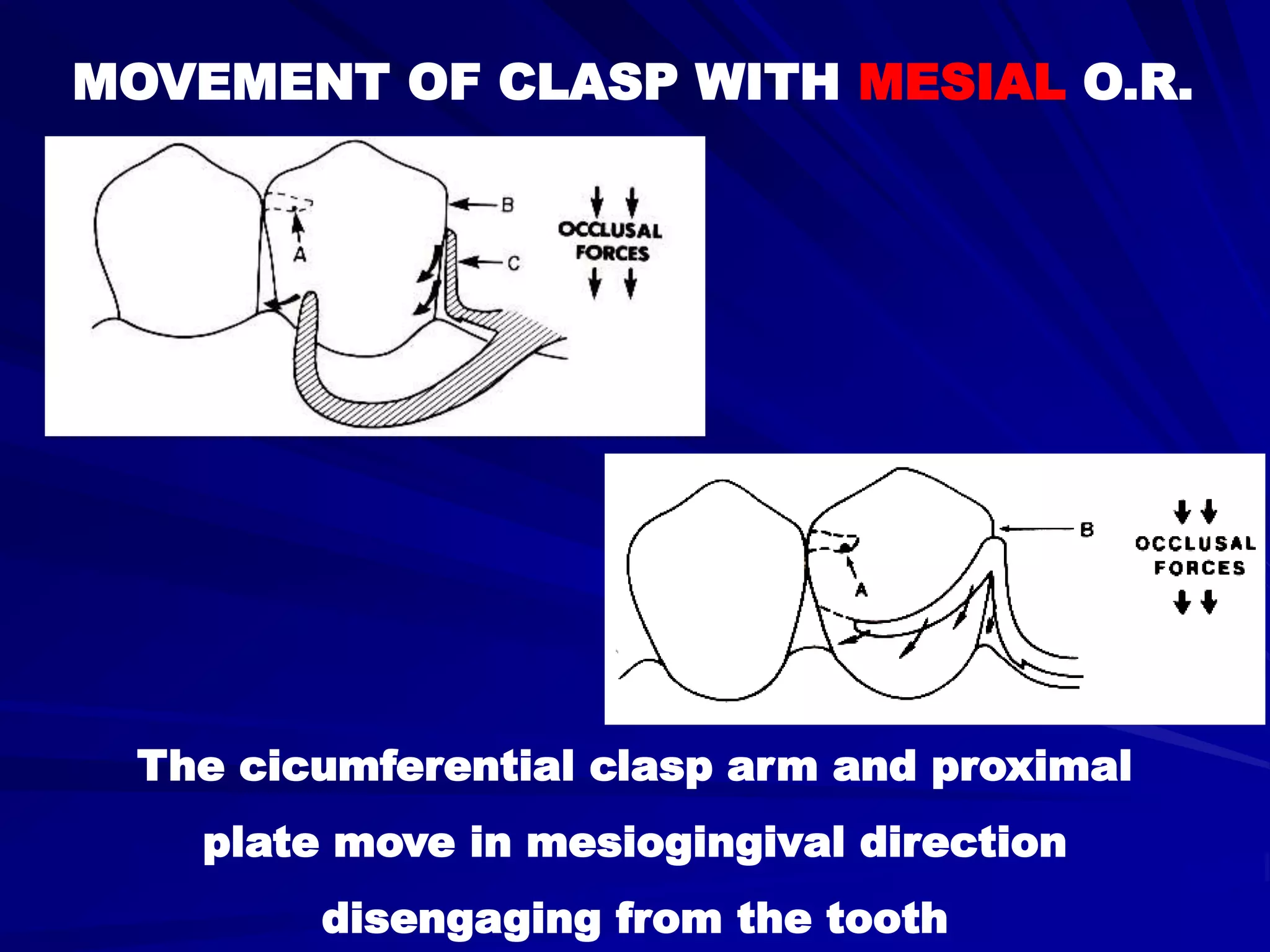 B- Retention of Removable Partial Dentures | PPT