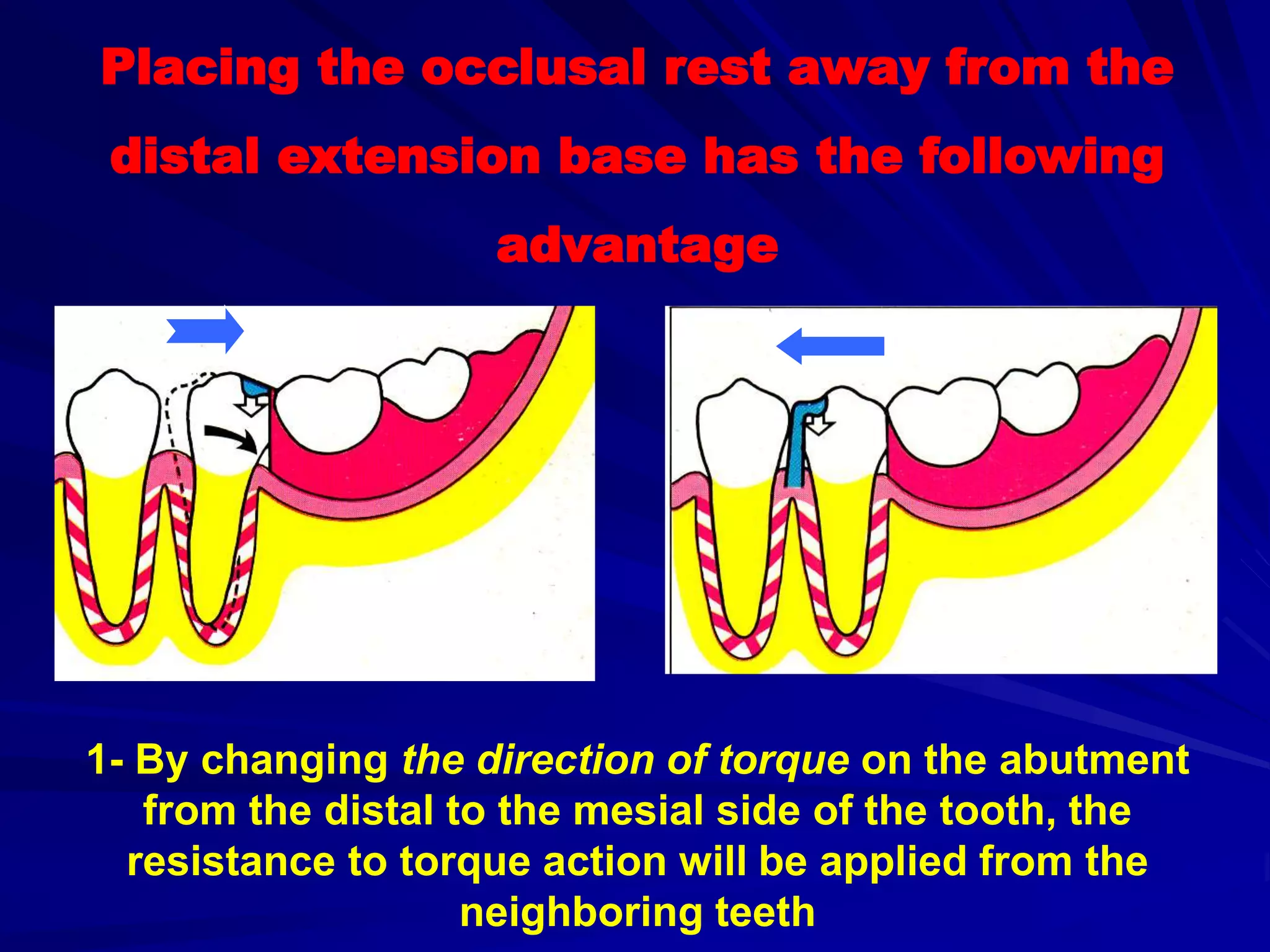 B- Retention of Removable Partial Dentures | PPT
