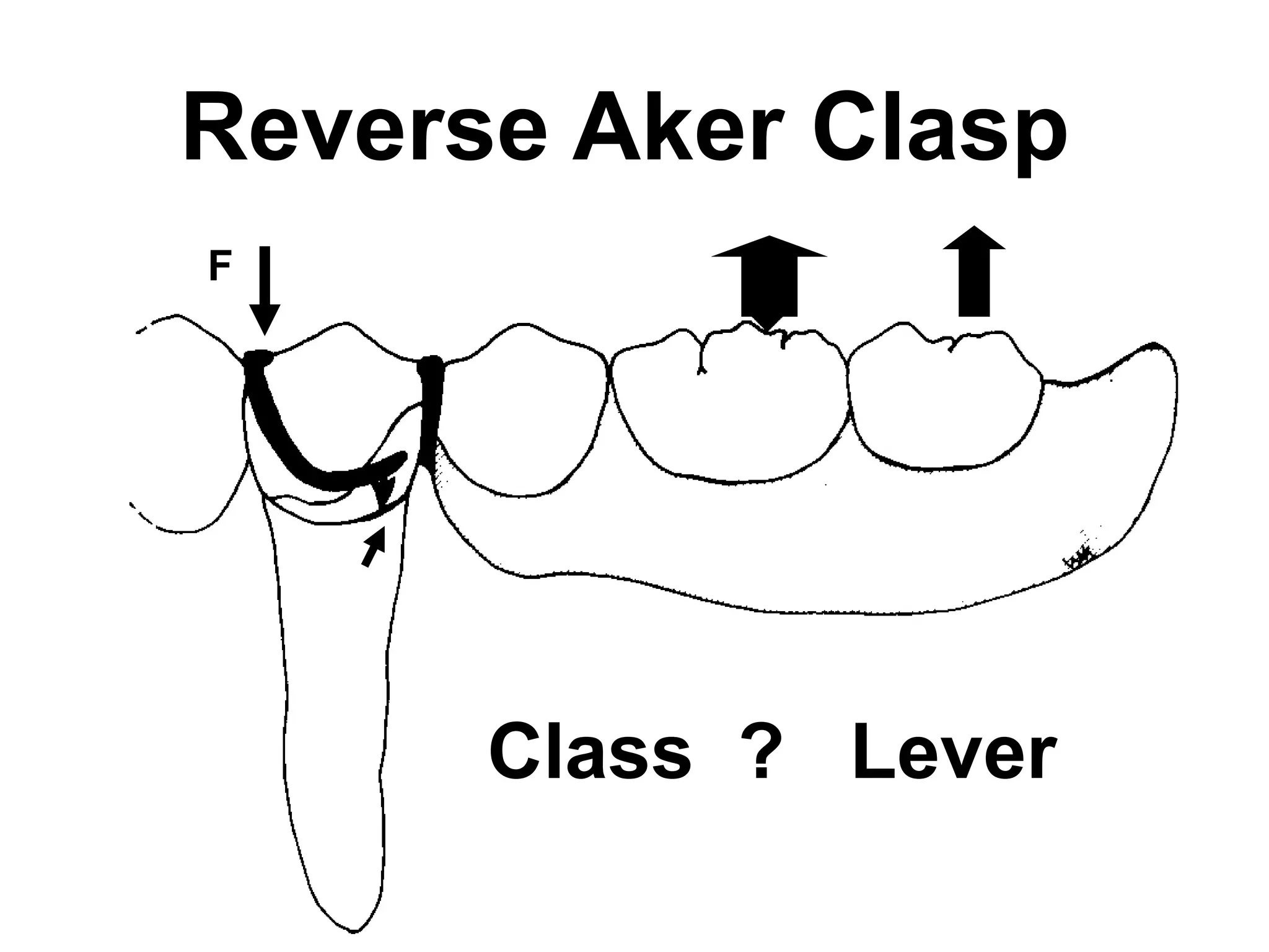 B- Retention of Removable Partial Dentures | PPT