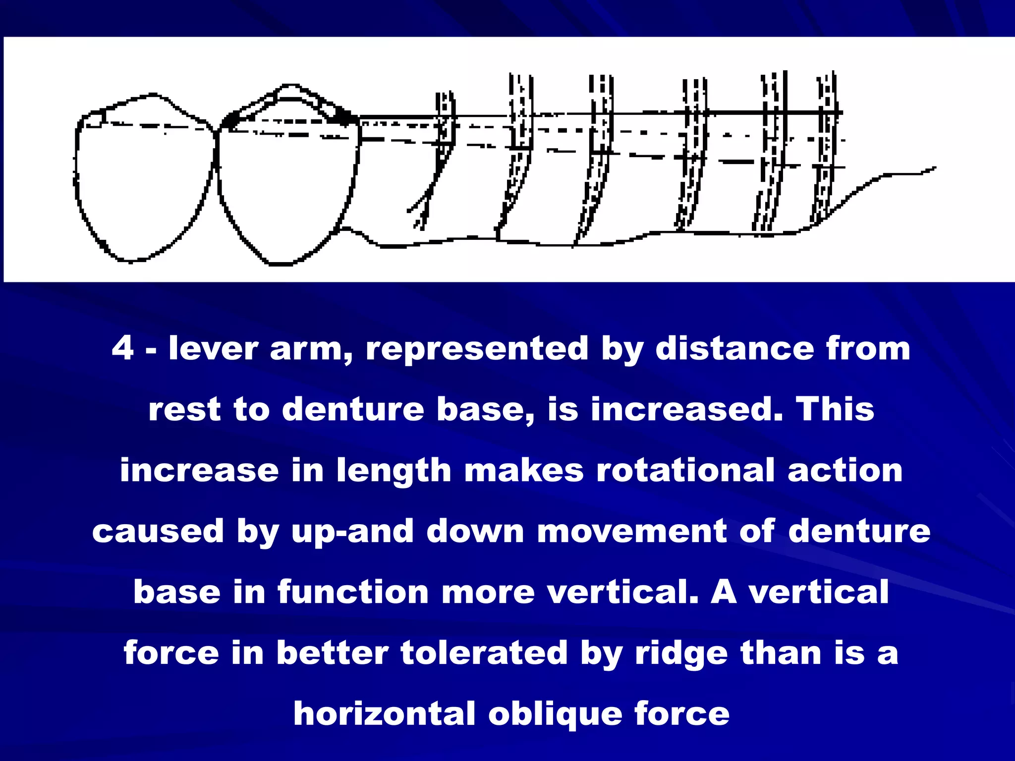 B- Retention of Removable Partial Dentures | PPT