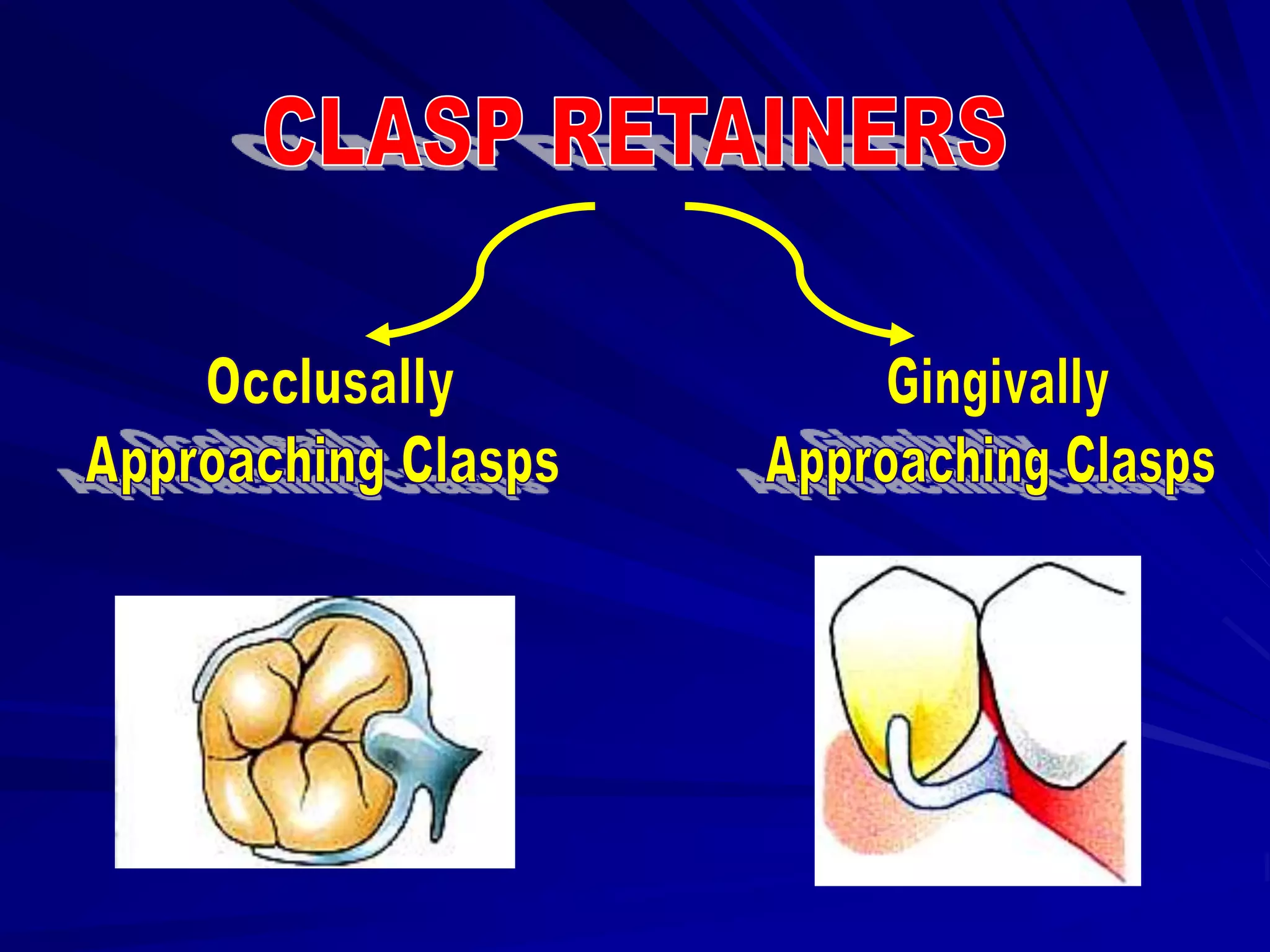 B- Retention of Removable Partial Dentures | PPT