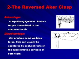 B- Retention of Removable Partial Dentures | PPT