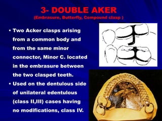 B- Retention of Removable Partial Dentures | PPT