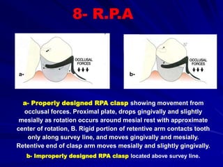 B- Retention of Removable Partial Dentures | PPT