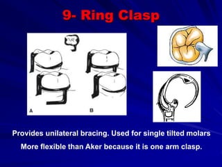 B- Retention of Removable Partial Dentures | PPT