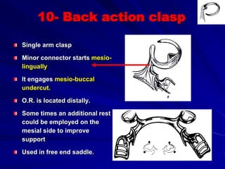B- Retention of Removable Partial Dentures | PPT