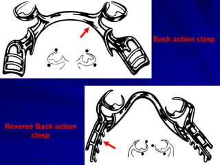 B- Retention of Removable Partial Dentures | PPT