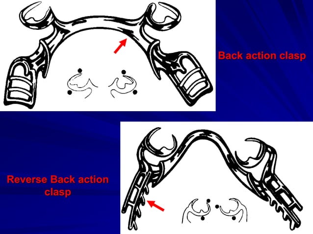 B- Retention of Removable Partial Dentures | PPT | Oral care | Personal ...