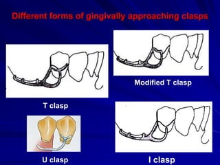 B- Retention of Removable Partial Dentures | PPT