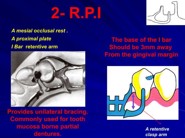 B- Retention of Removable Partial Dentures | PPT | Oral care | Personal ...