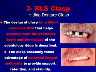 B- Retention of Removable Partial Dentures | PPT