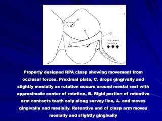 B- Retention of Removable Partial Dentures | PPT