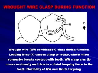 B- Retention of Removable Partial Dentures | PPT