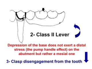 B- Retention of Removable Partial Dentures | PPT