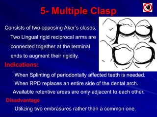 B- Retention of Removable Partial Dentures | PPT