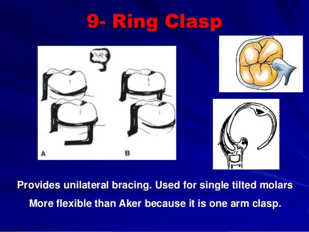 B- Retention of Removable Partial Dentures