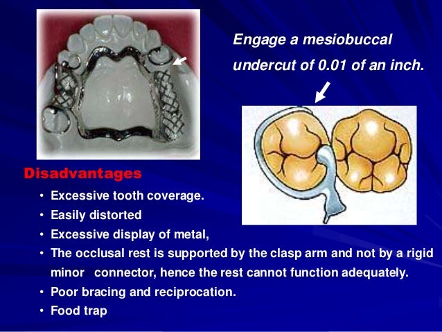 B- Retention of Removable Partial Dentures