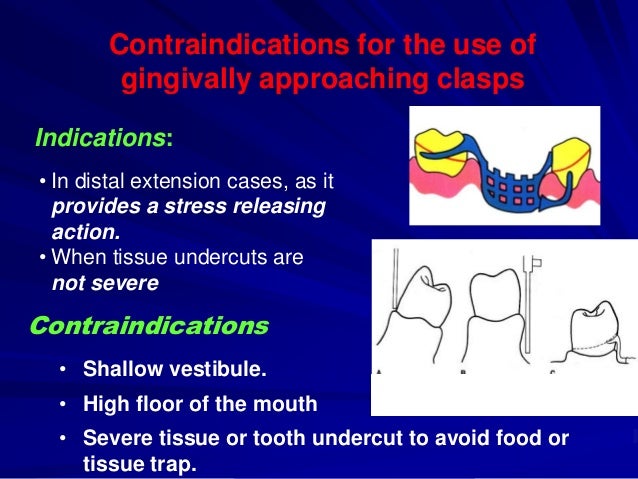 B- Retention of Removable Partial Dentures