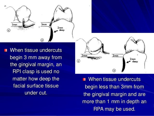 B- Retention of Removable Partial Dentures
