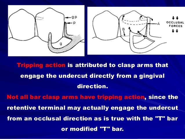 B- Retention of Removable Partial Dentures