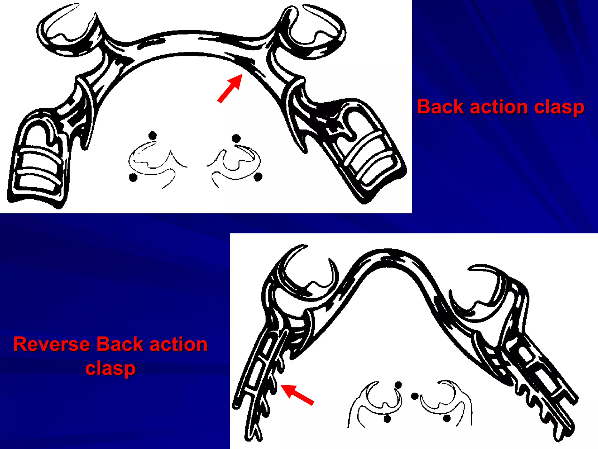 b- Retainers of RPDs | PPT