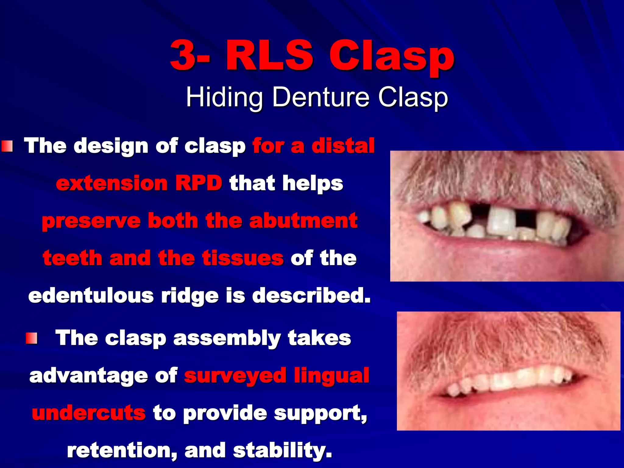 b- Retainers of RPDs | PPT