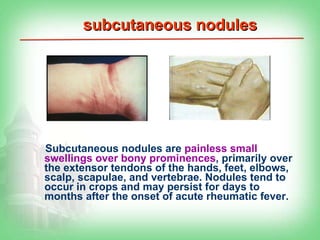 Subcutaneous Nodules Rheumatic Fever