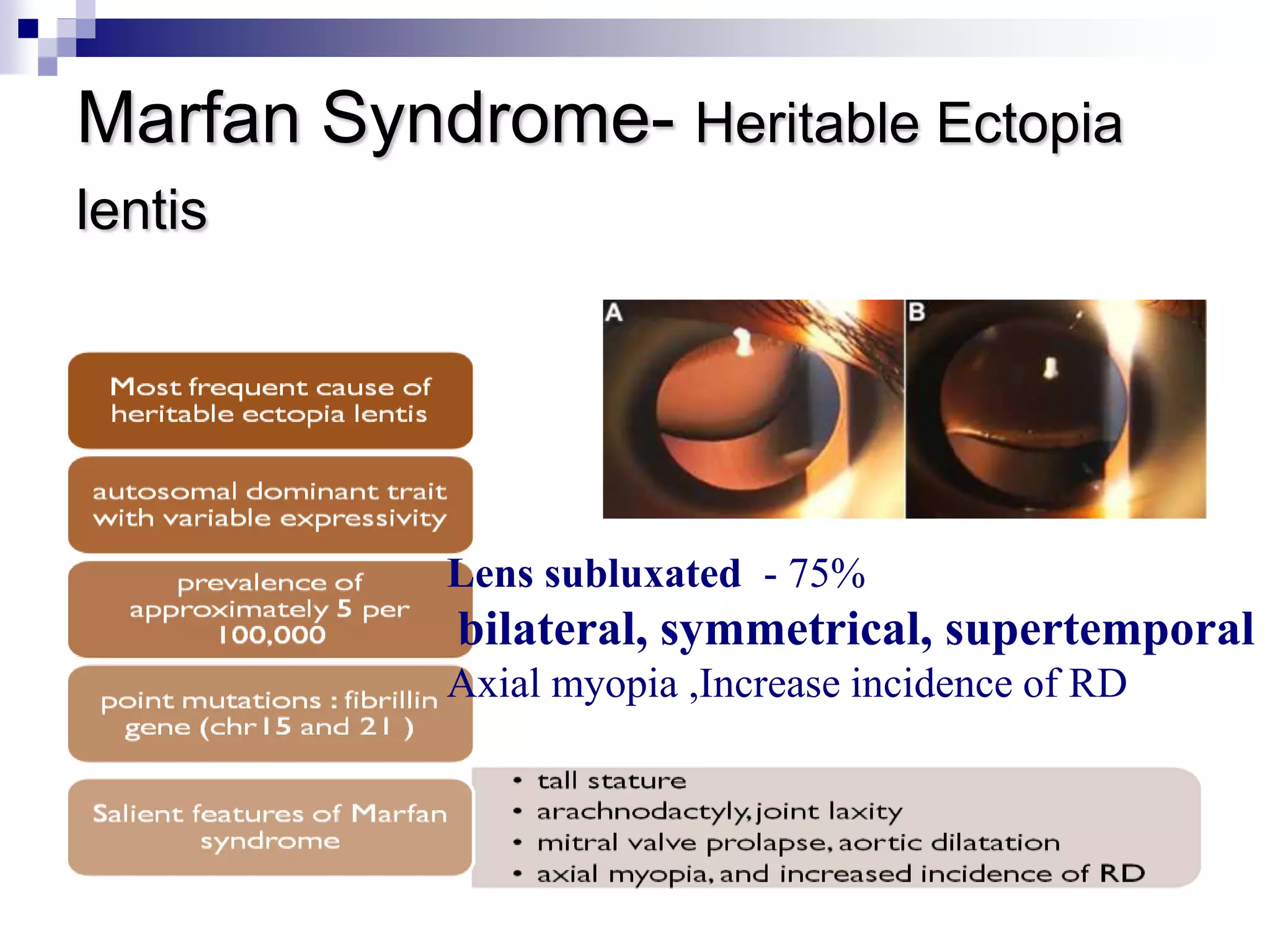 10-subluxated-lens.ppt