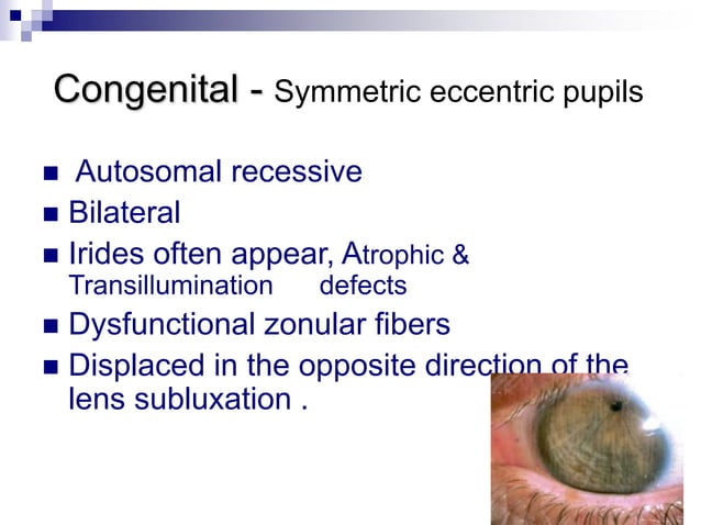 10-subluxated-lens.ppt | Eye and Vision Conditions | Diseases and ...