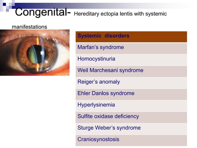 10-subluxated-lens.ppt | Eye and Vision Conditions | Diseases and ...