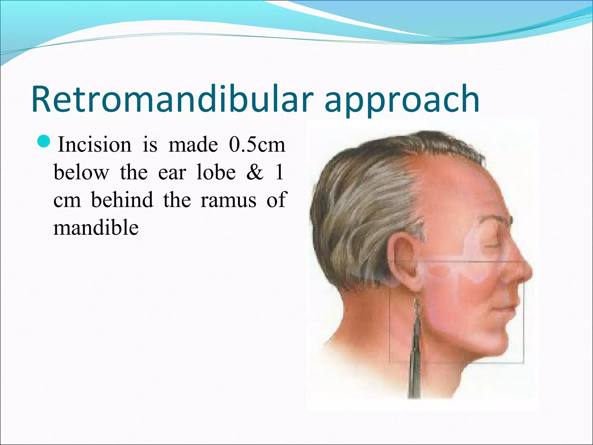 surgical approaches to the mandibular condyle | PPT