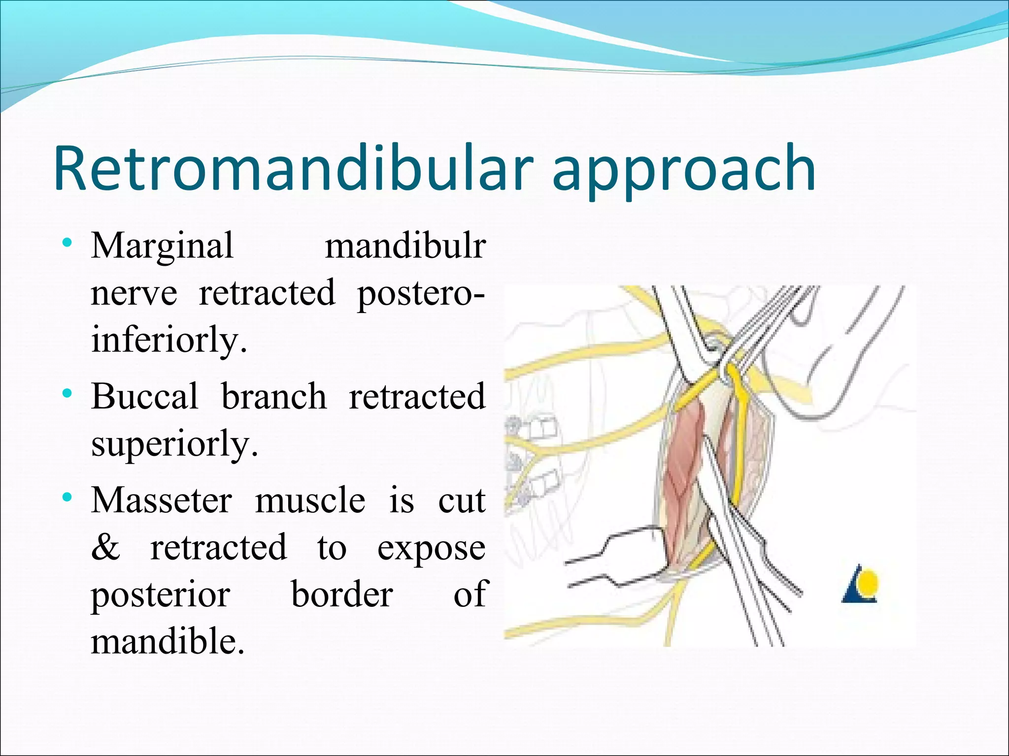 surgical approaches to the mandibular condyle | PPT