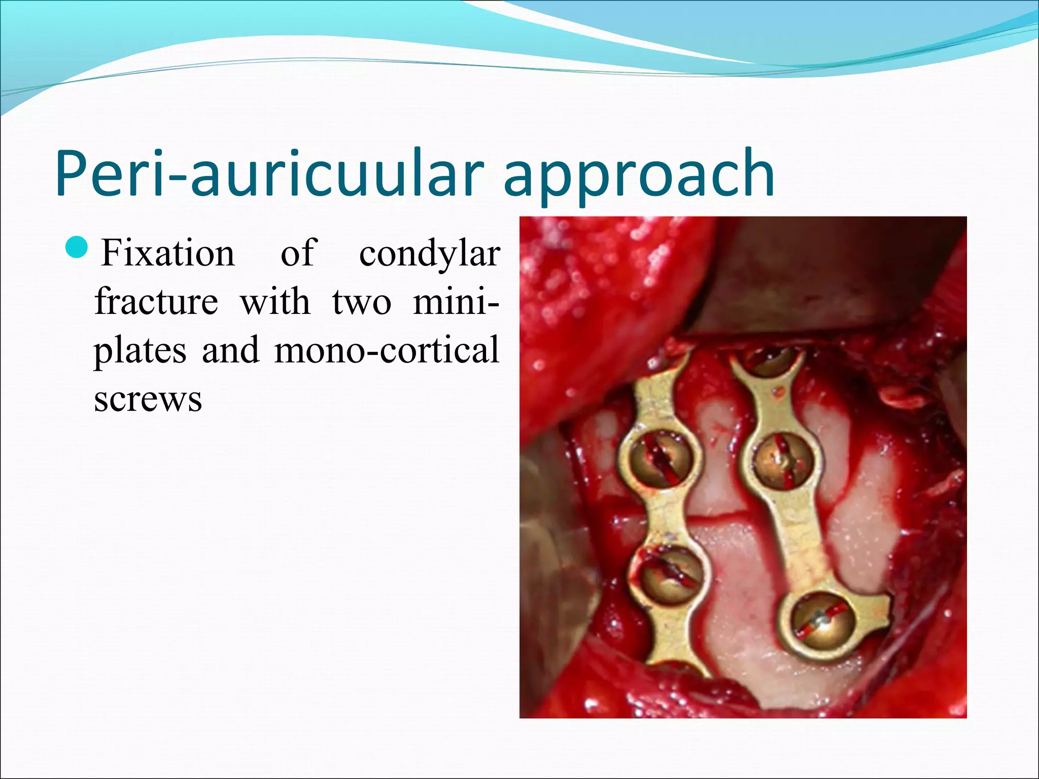 surgical approaches to the mandibular condyle | PPT