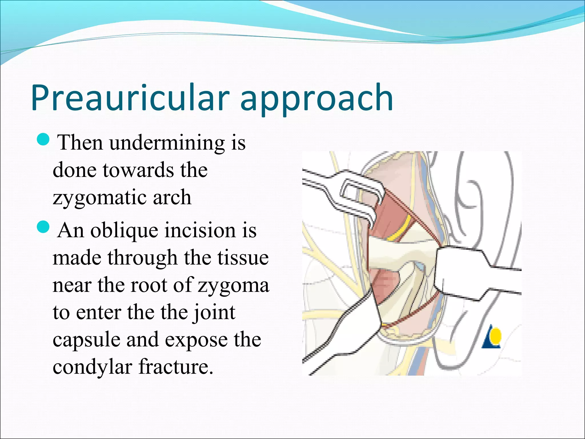 surgical approaches to the mandibular condyle | PPT