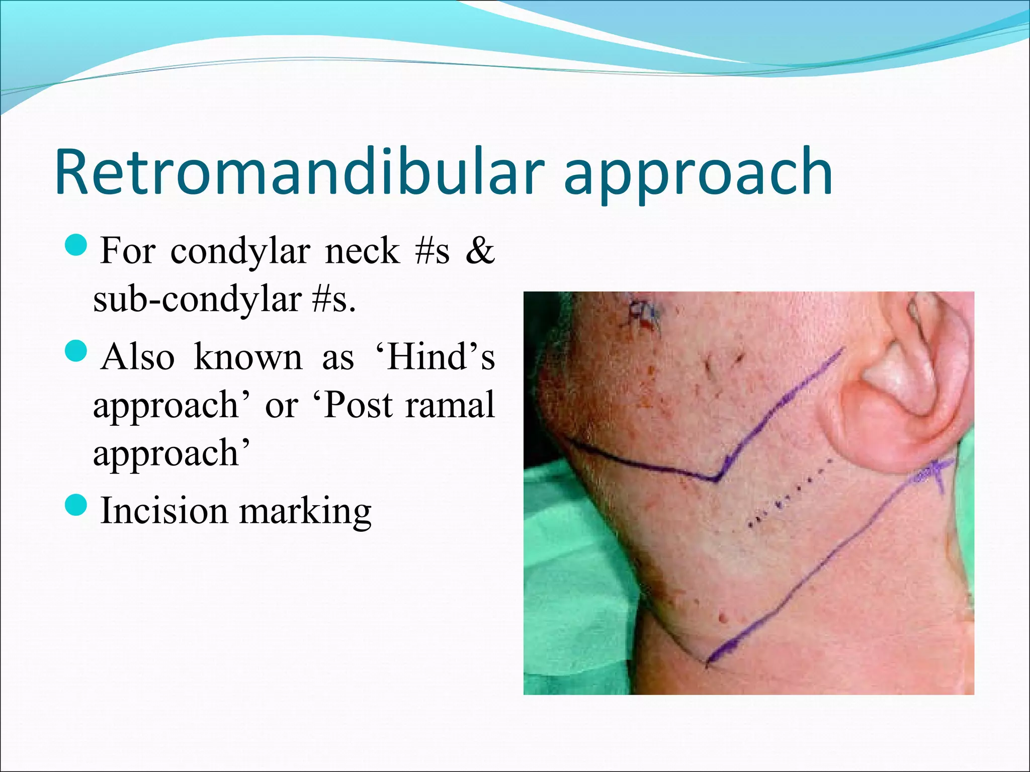 surgical approaches to the mandibular condyle | PPT