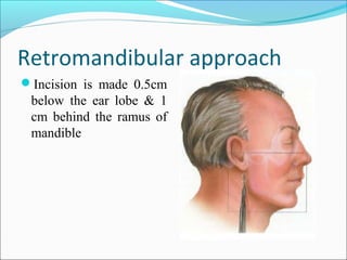 surgical approaches to the mandibular condyle | PPT