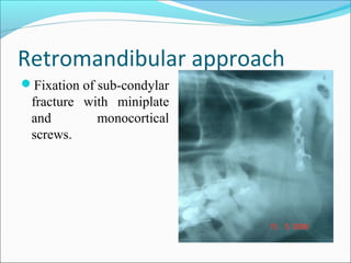 surgical approaches to the mandibular condyle | PPT